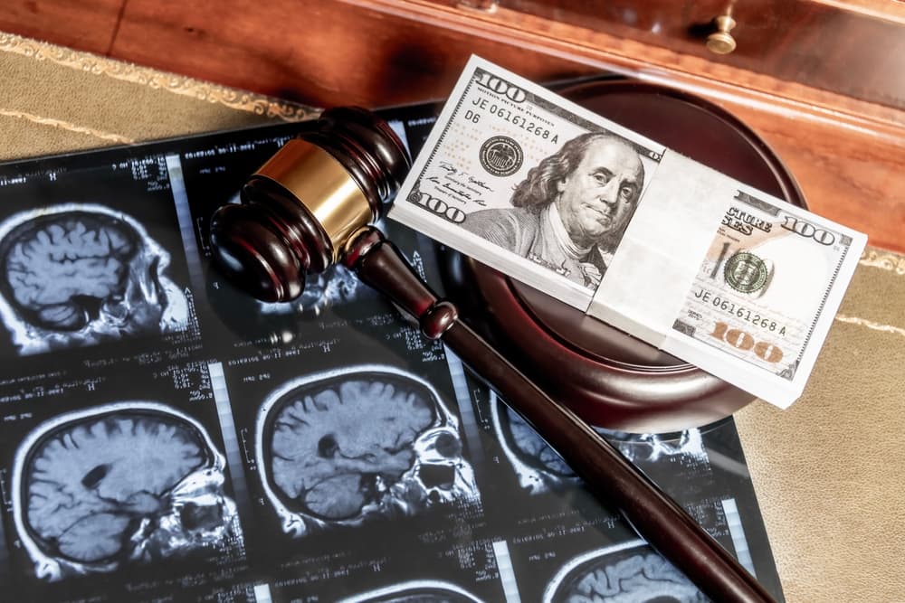 What are the Long-term Effects of a Brain Injury? - Alexander Law Group LLP